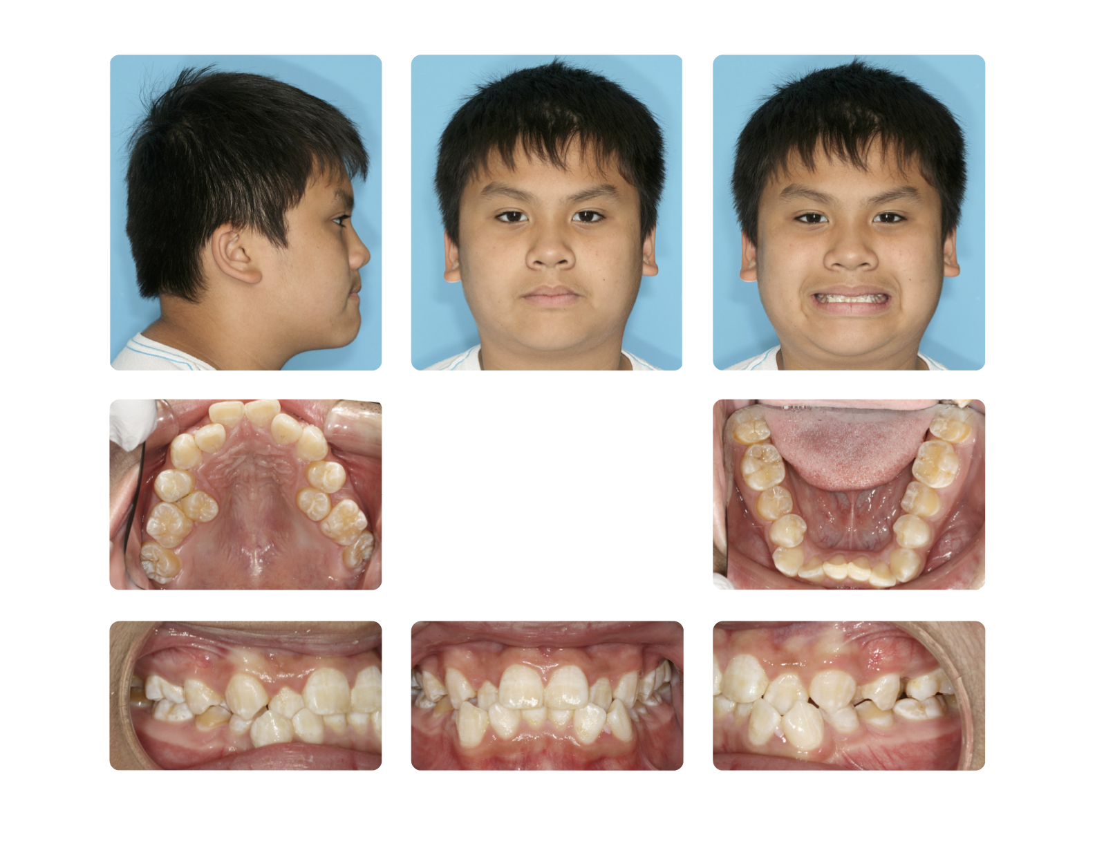 Braces before and after | San Antonio, TX | Senties Family Orthodontics